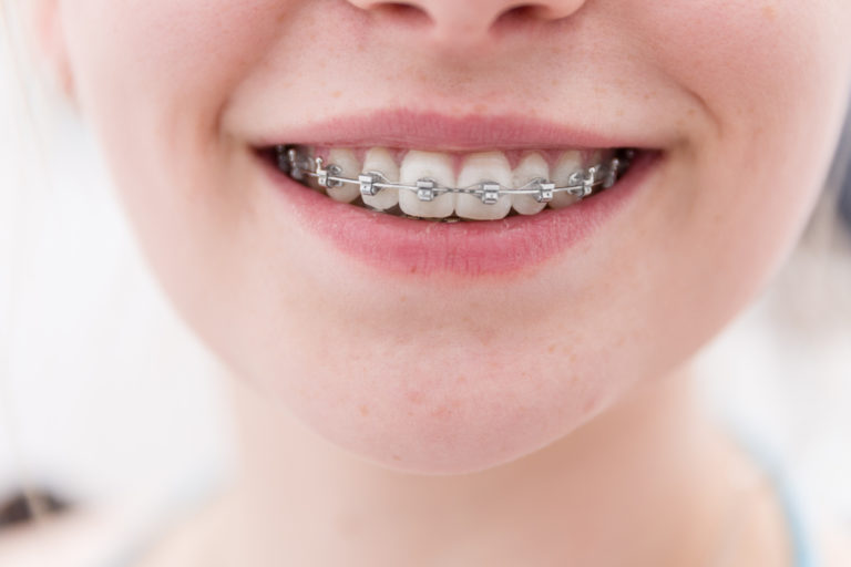 What Causes White Spots On Teeth After Braces Thomas Orthodontics 1115