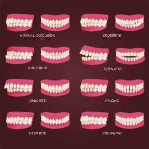 Types of Malocclusions: Understanding Your Smile's Alignment - Thomas ...